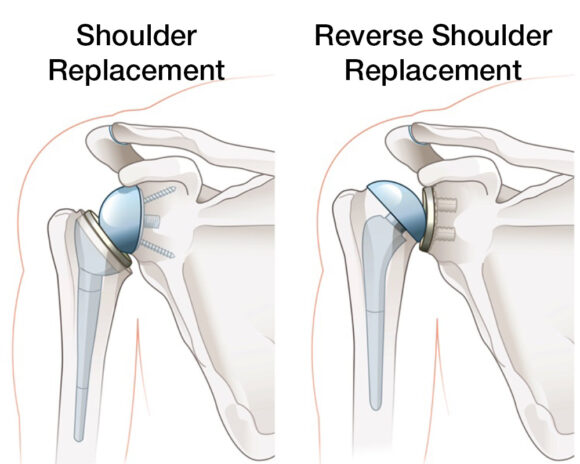 Shoulder Surgery | Glacial Ridge Health System